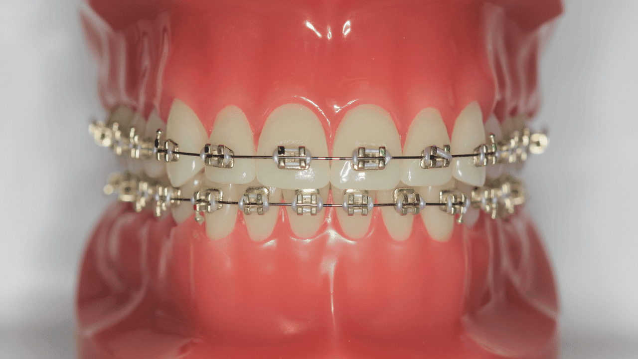 5 Types Of Braces: Which Is Best For You?