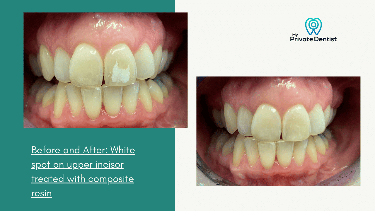 What Causes White Spots On Teeth? With 5 Treatments
