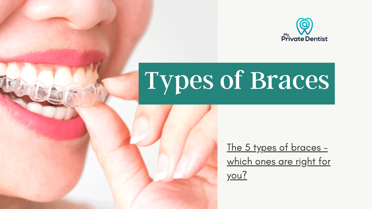 5 Types Of Braces: Which Is Best For You?