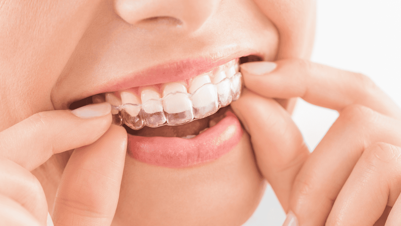 5 Types Of Braces: Which Is Best For You?
