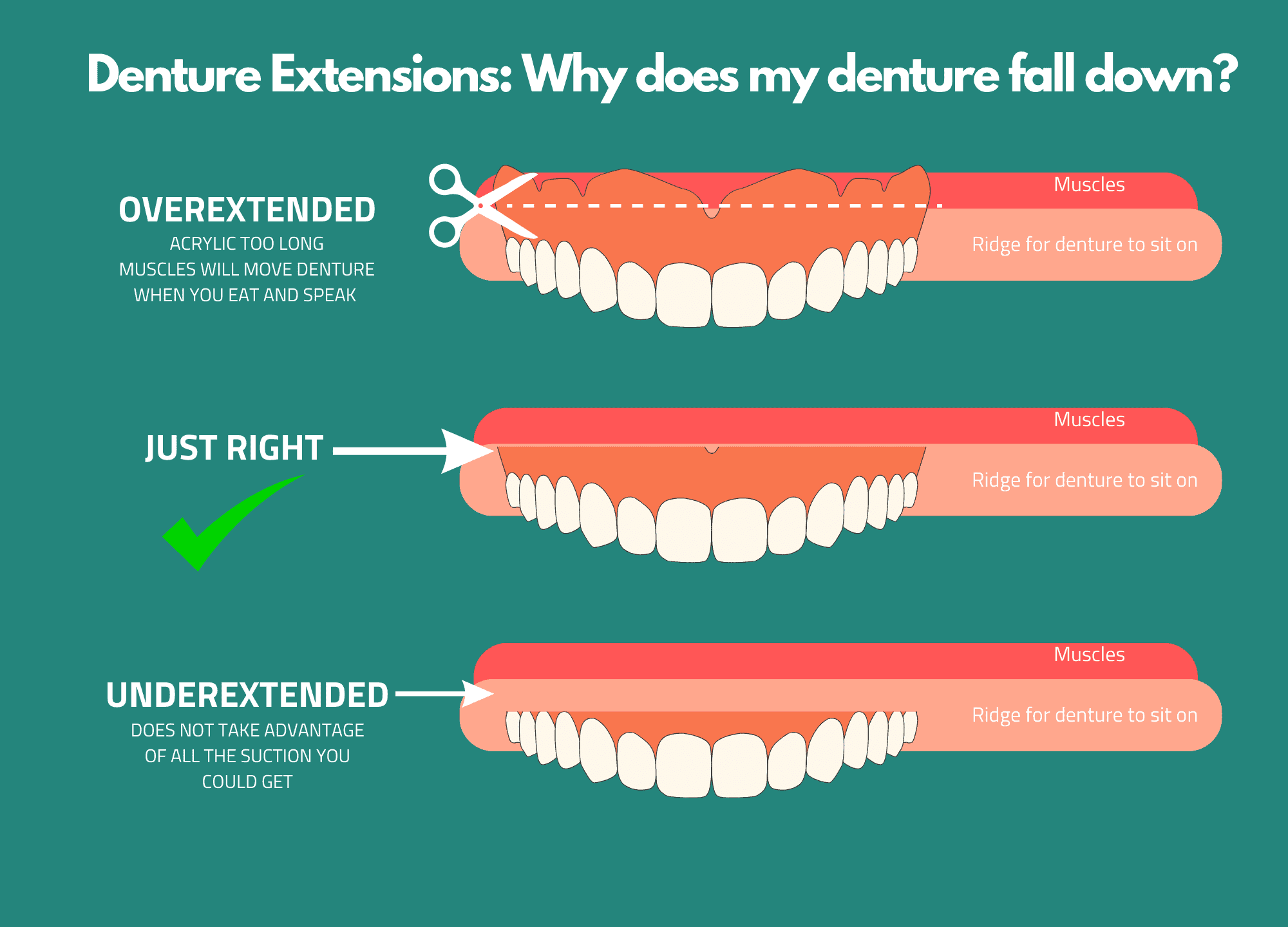 5 Best Denture Adhesives (2025): For A Secure, All-Day Hold - My ...