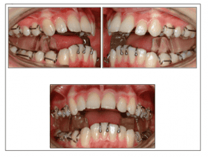 Twin Blocks: Your Essential Guide - My Private Dentist