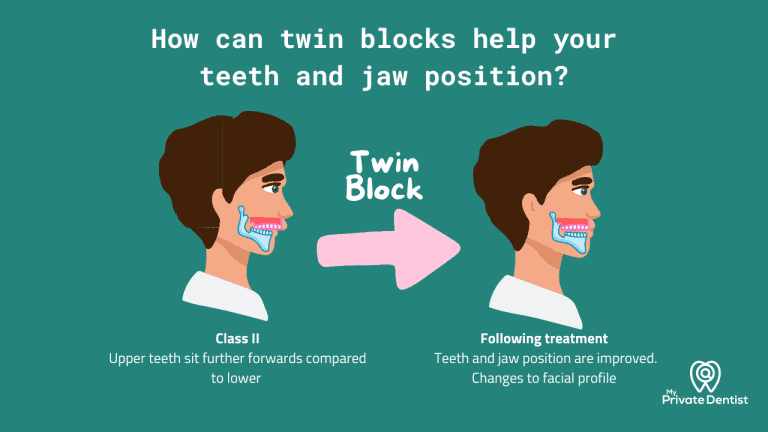 Twin Blocks: Your Essential Guide - My Private Dentist